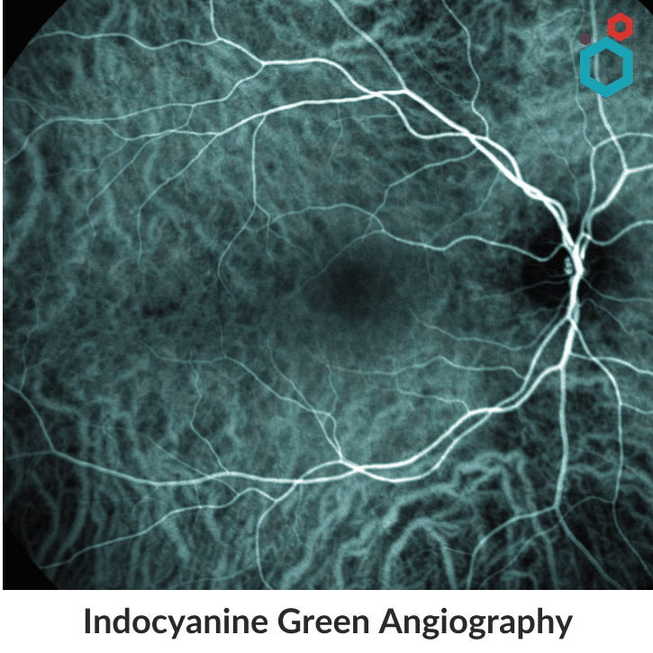 Indocyanine Green | Uses in Medical Imaging & Surgery